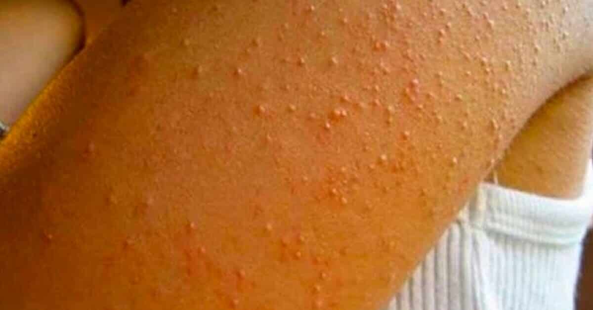 ¿Bolitas rojas en los brazos? Conozca los síntomas de la alergia al gluten