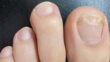 Con estos tratamientos caseros ¡Olvídese de los hongos en las uñas! - e ...