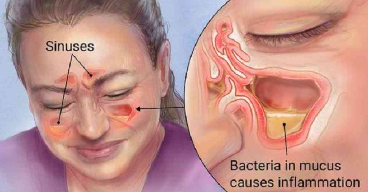 Acabe Con La Sinusitis Y La Rinitis Preste Atenci n A Este Acabe Con La Sinusitis Y La Rinitis Preste Atenci n A Este