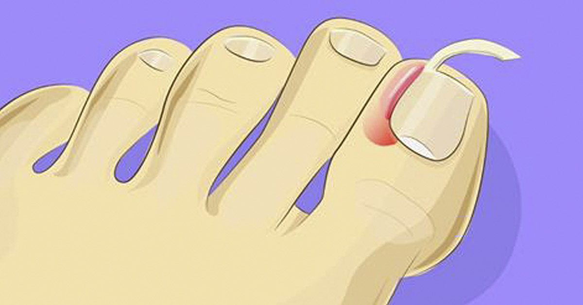 Sepa cómo tratar las uñas enterradas - e-Consejos