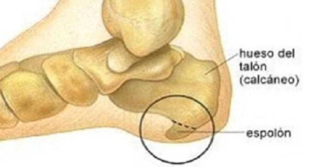 Aprenda un tratamiento para el espolón calcáneo con una receta casera