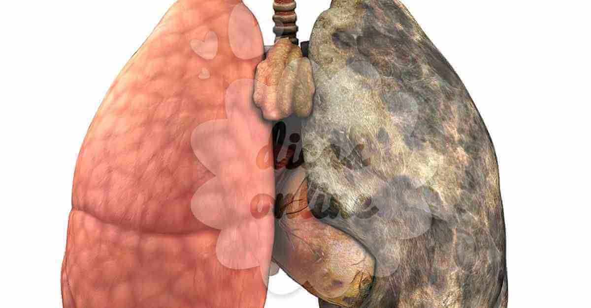 ¿Fue fumador? ¡Sepa cómo limpiar sus pulmones!