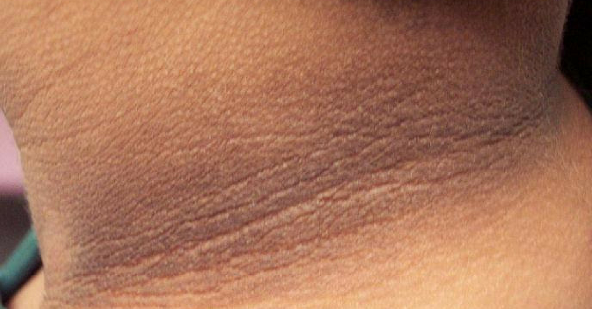 5 Tratamientos caseros para desaparecer el cuello oscuro