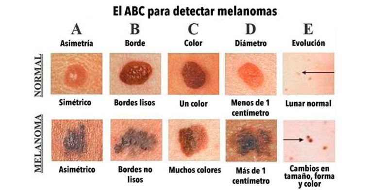 Diferencias entre lunares malignos y benignos