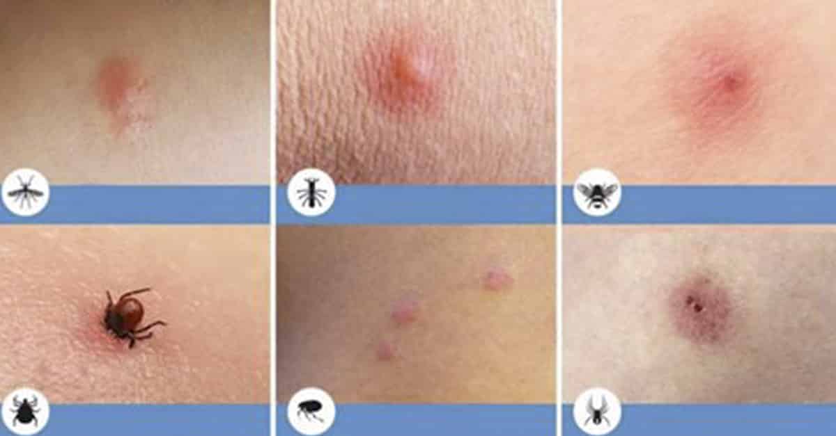 Aprenda a reconocer qué insecto le ha picado por las características de ...