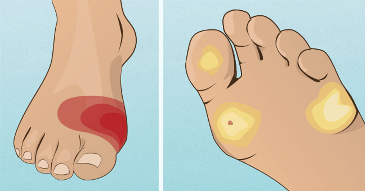 11 maneras de tratar problemas en los pies