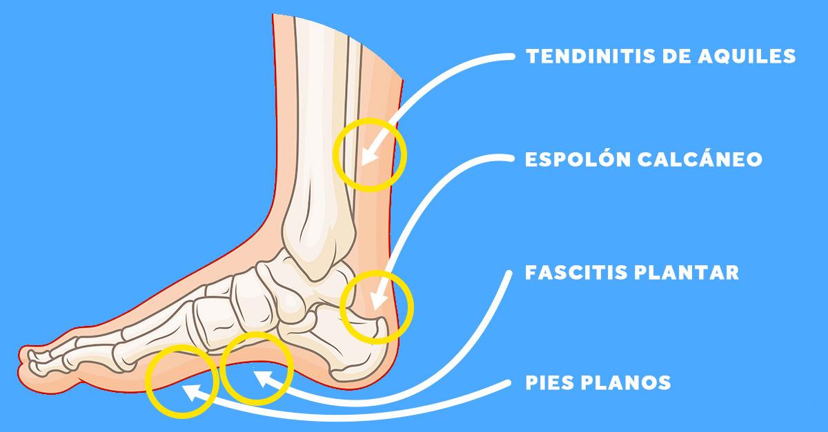 8 consejos para evitar y aliviar por completo el dolor en los pies