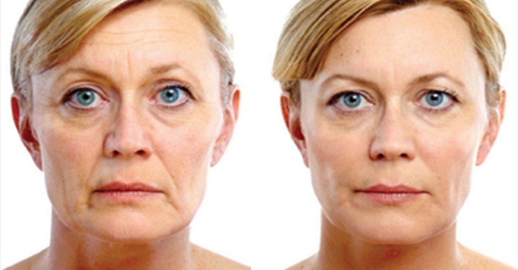 5 recetas caseras para combatir la flacidez facial