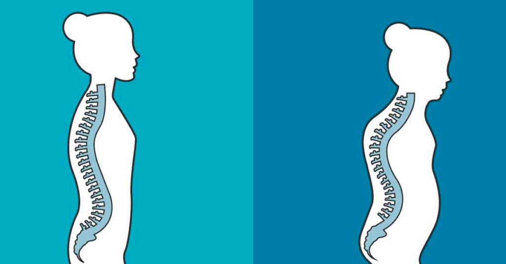 Cifosis: ¿Qué es y cómo se trata?