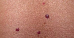 Lunares rojos: qué son y cómo tratarlos