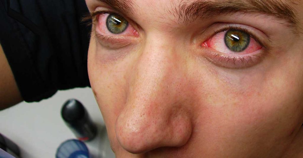 4 Causas de los ojos rojos