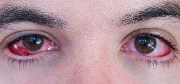 4 Causas de los ojos rojos