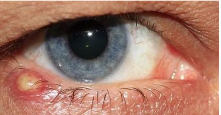 Orzuelo: síntomas, causas y cómo curarlo