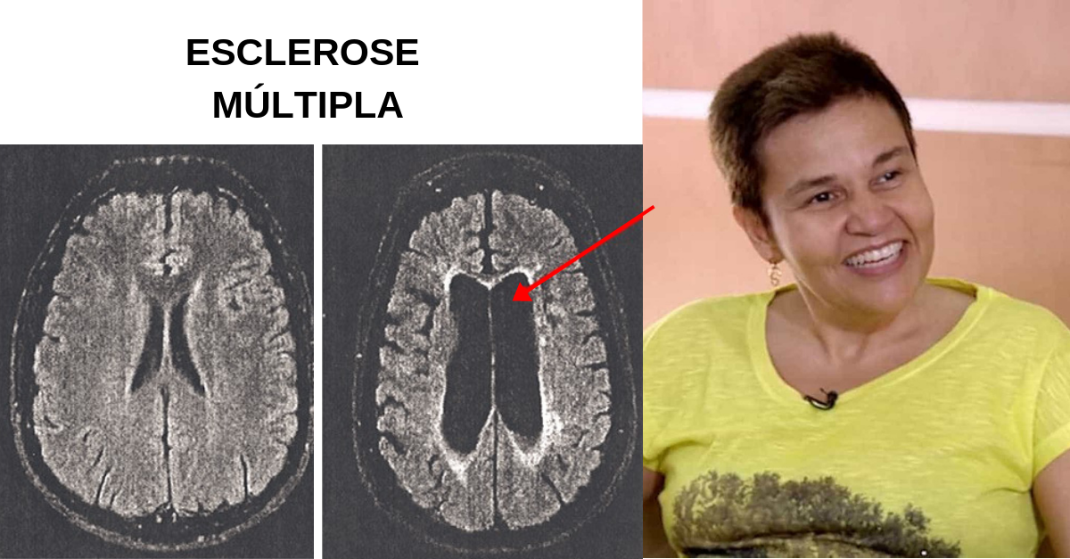 8 Síntomas de esclerosis múltiple