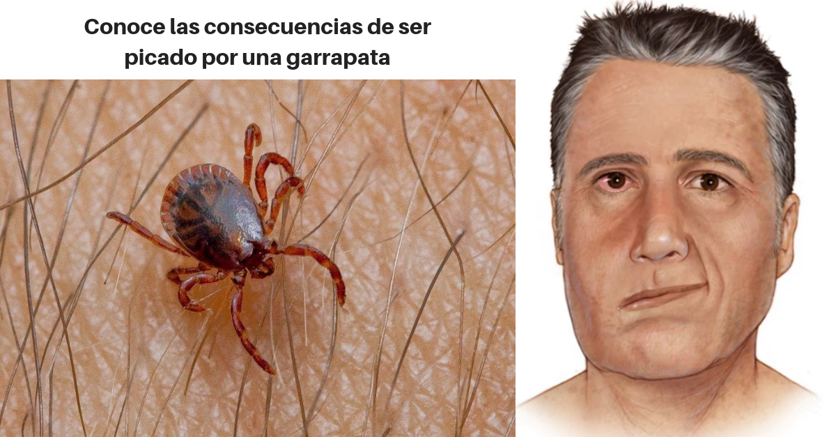 ¿Qué Síntomas Tiene Y Cómo Se Trata La Enfermedad De Lyme En – QIZR