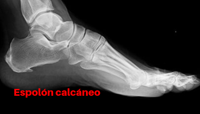 Espolón en el talón: qué es, síntomas y tratamientos - e-Consejos