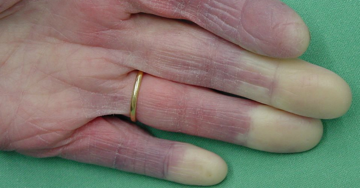 Qué es y cómo evitar los síntomas del síndrome de Raynaud - e-Consejos