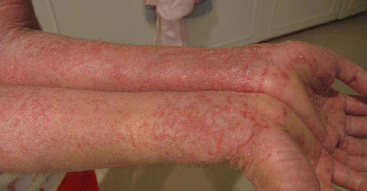 Atopia: conoce todo sobre el llamado "asma en la piel"