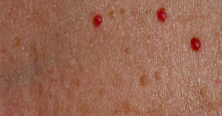 Ampollas de sangre en la piel: qué son, por qué ocurren y qué hacer