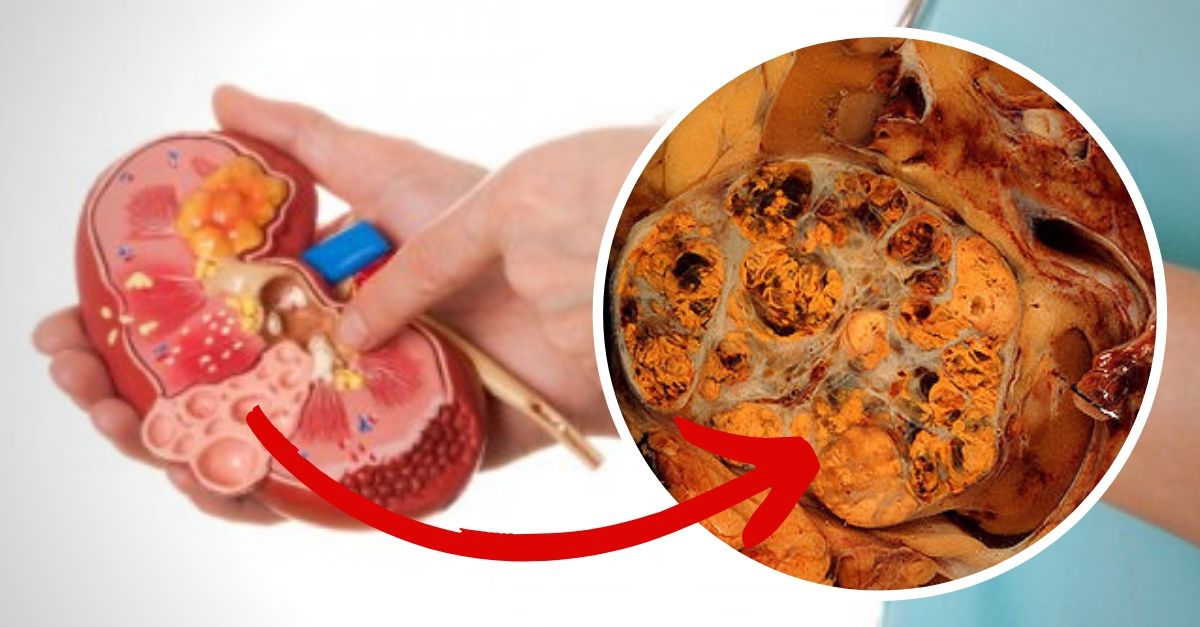 Cáncer en los riñones: síntomas, causas, tratamiento y prevención