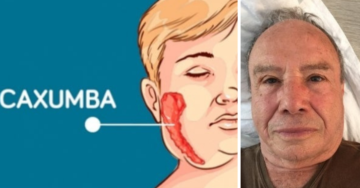 ¿Qué es, cuáles son los síntomas y cuál es el tratamiento de las paperas?