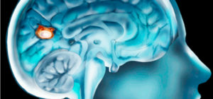¿Qué es la neurocisticercosis?