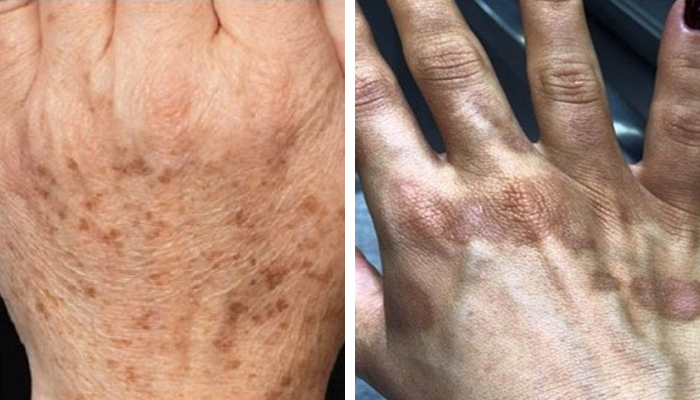 Remedios naturales para eliminar las manchas de las manos