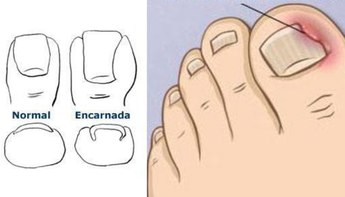Cómo librarse de las uñas encarnadas sin ir al médico