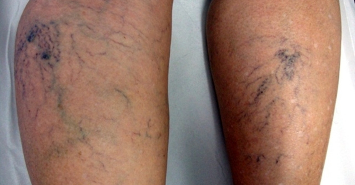 Descubre cómo aliviar el dolor de las varices