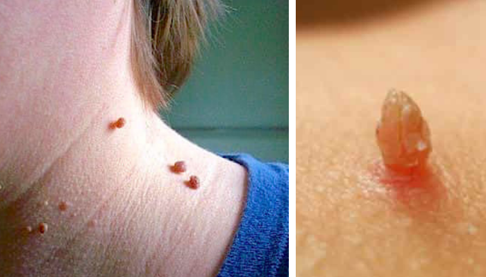 ¿Tiene verrugas y no sabe como removerlas? Aprenda algunas técnicas ...