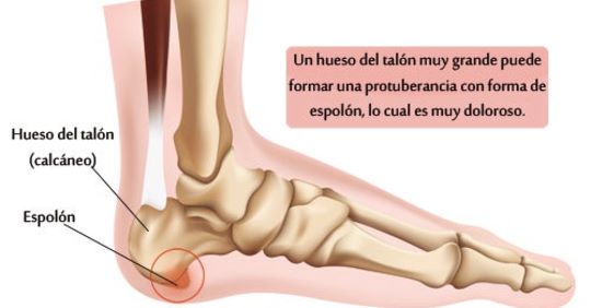 Espolón en el talón: qué es, síntomas y tratamientos