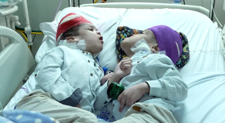 Los gemelos unidos por el cráneo fueron separados en la cirugía