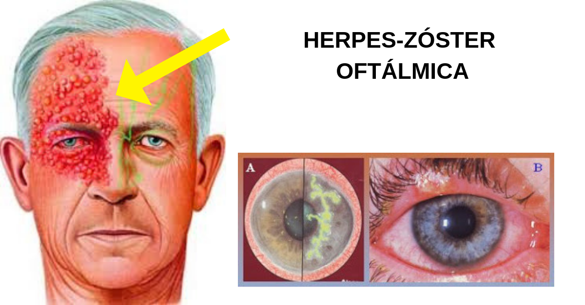 Herpes Zoster Oftalmico Você Conhece O Herpes Zóster? Saiba Mais