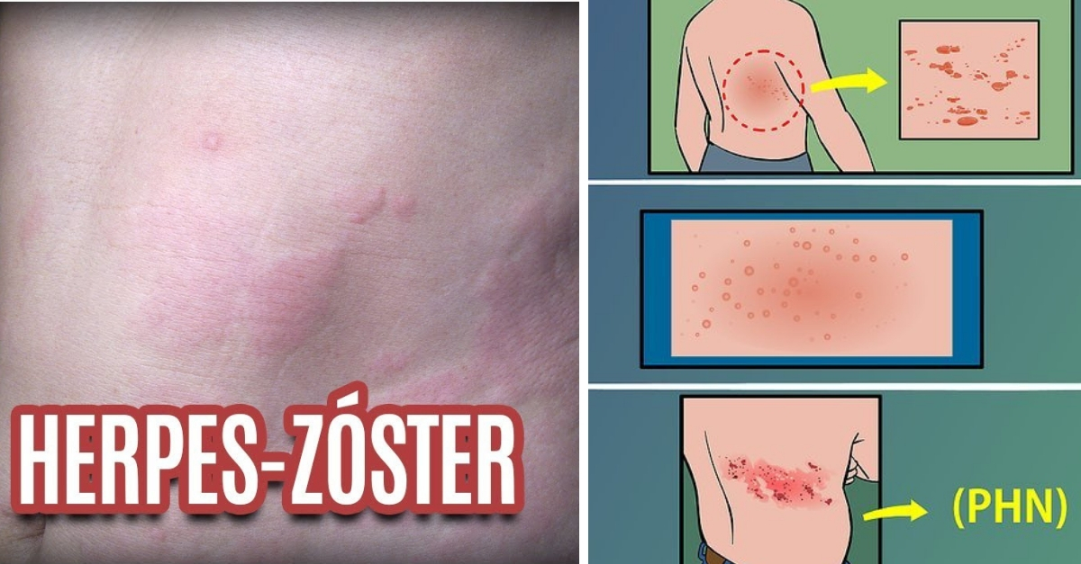 Tratamientos para el herpes zóster y posibles complicaciones