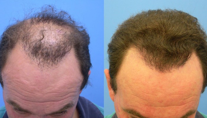 Injerto capilar: qué es y cómo funciona