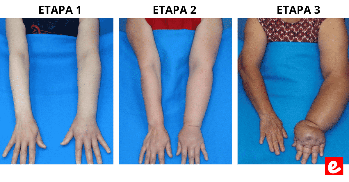 Linfedema: descubre qué es y cómo tratar este problema vascular