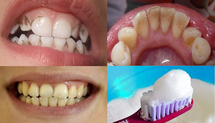 Consiga dientes más blancos con estos 2 ingredientes naturales