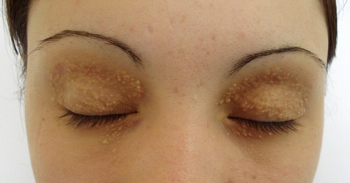 ¿Tienes milias? ¡Aprende a deshacerte de ellas!