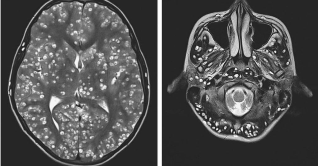 ¿Qué es la neurocisticercosis?