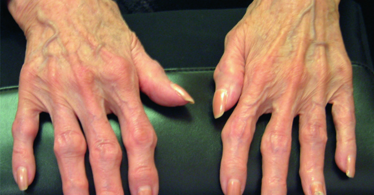 Nódulo De Bouchard E Heberden - RETOEDU