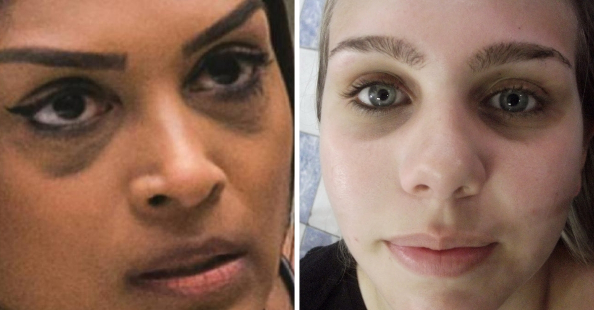 Ojeras rojizas: causas y cómo tratarlas