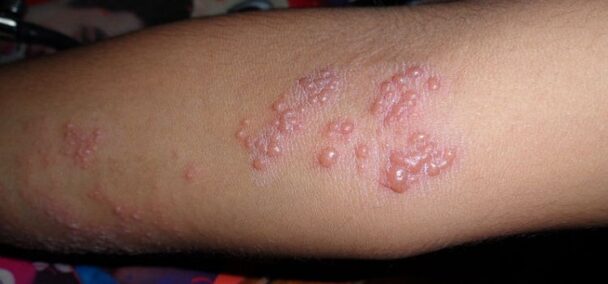 Herpes simple: qué es, causas y tratamiento