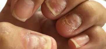 Psoriasis: qué es, tipos, síntomas, causas y tratamiento