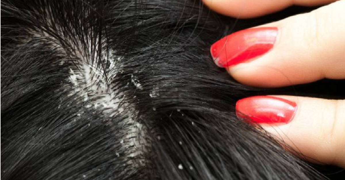 8 Remedios caseros para la caspa