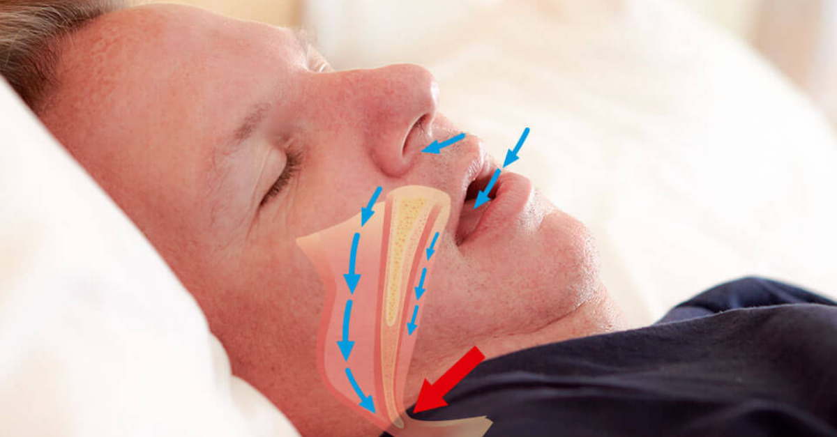 ¿Cuáles son las enfermedades y afecciones que pueden tener el ronquido ...