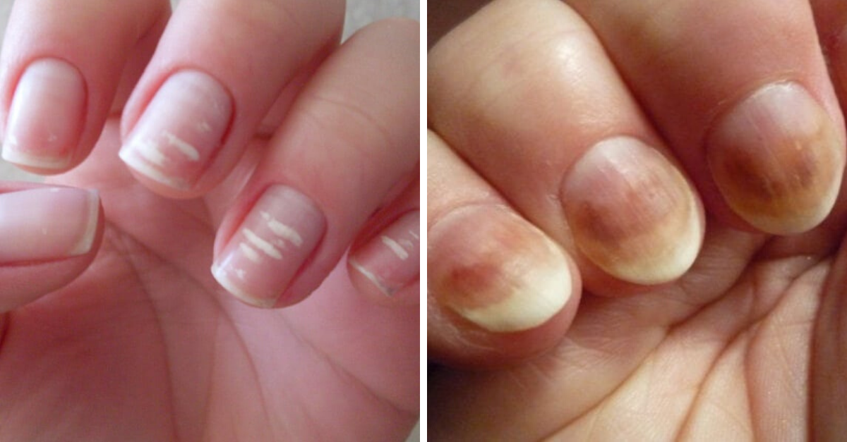 10 Señales de enfermedades que transmiten las uñas