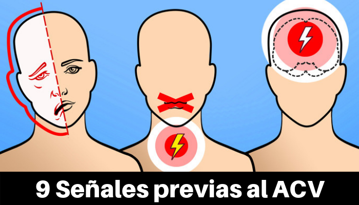 Identifique las primeras señales a un accidente cerebrovascular