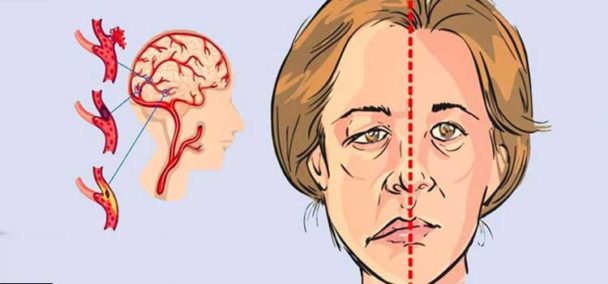 4 Síntomas De Derrame Cerebral Y Factores De Riesgo