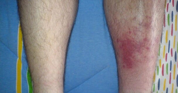 ¿Cuál es el tratamiento para la erisipela?