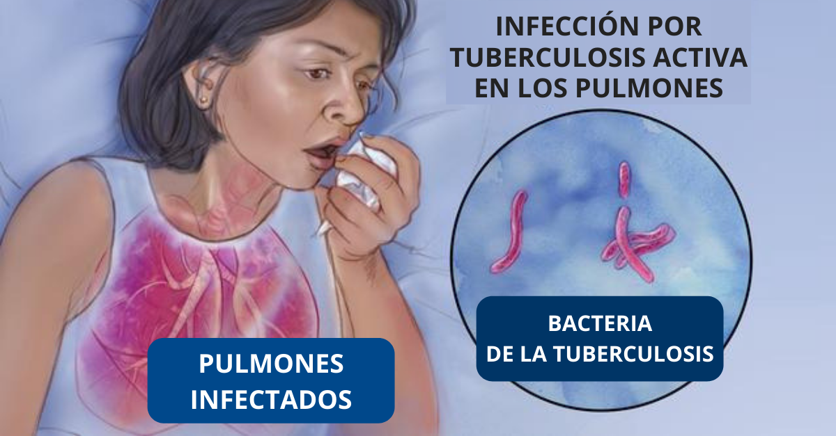 La tuberculosis mata a casi 5.000 personas todos los días